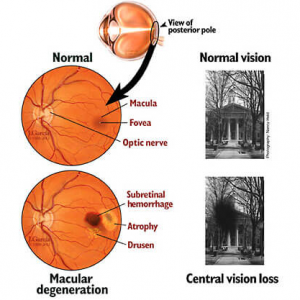 Age-Related Macular Degeneration Archives - Eye & Ear Foundation of ...