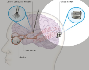 Cortical Vision: Can We See with Just Our Brain? - Eye & Ear Foundation of Pittsburgh
