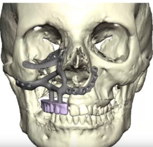 Mandibular and Maxillary 3D Modeling in Head and Neck Reconstruction ...